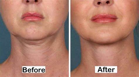 7 Proven Exercises to Lose Face Fat In 2 Days - Quoqlee